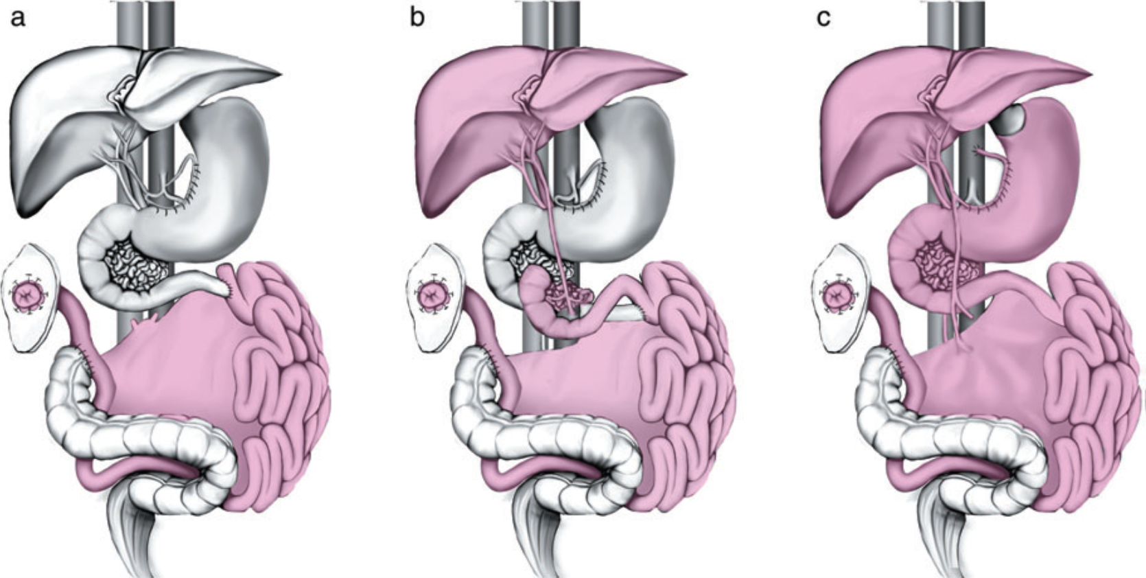Intestine Transplant - Organ India